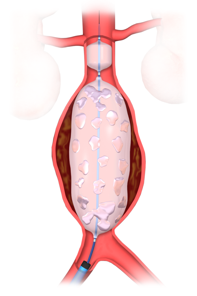 Nectero Medical – Nectero Medical is developing a novel treatment to ...